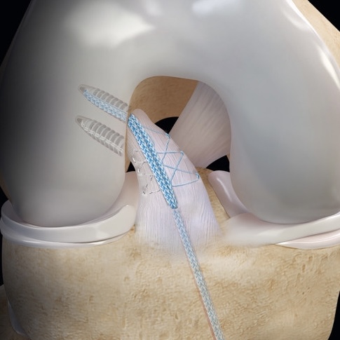 What is ACL Repair? – Health | Fitness | Lifestyle